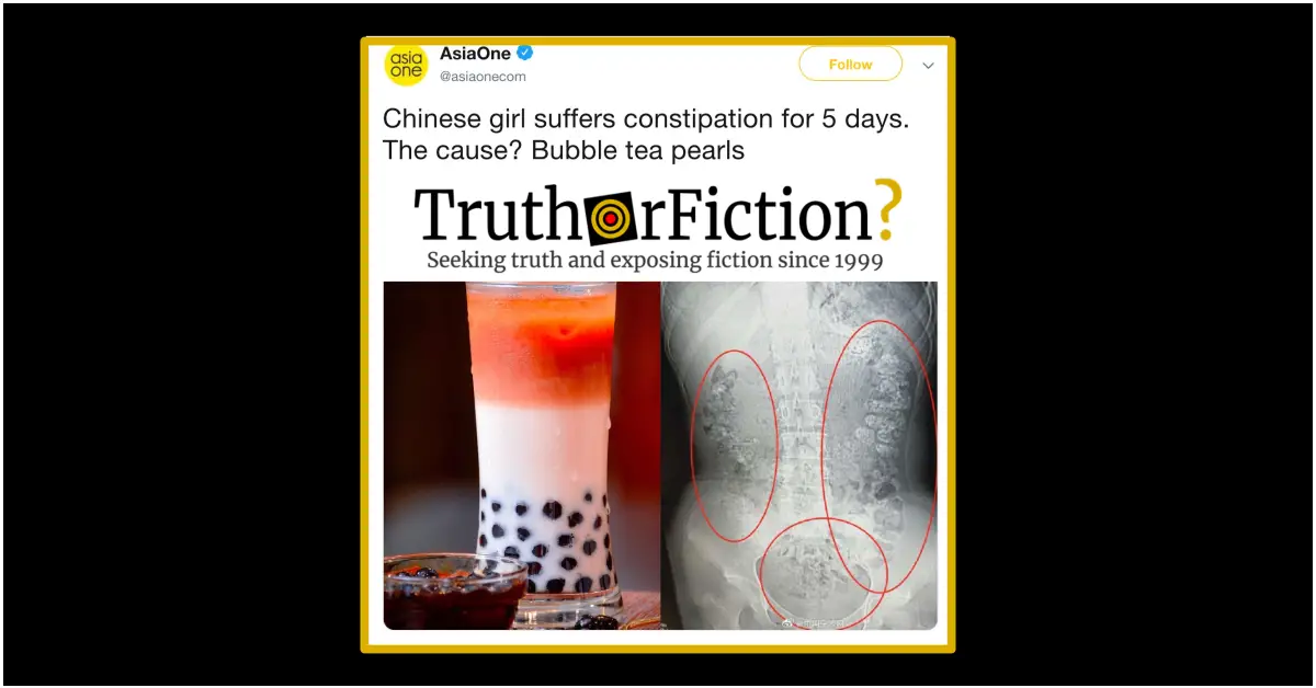 Does an X-Ray Show Hundreds of Undigested Boba Pearls in a Young ...