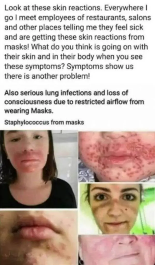 Is ‘Maskne’ a Sign of a Lung Infection? – Truth or Fiction?